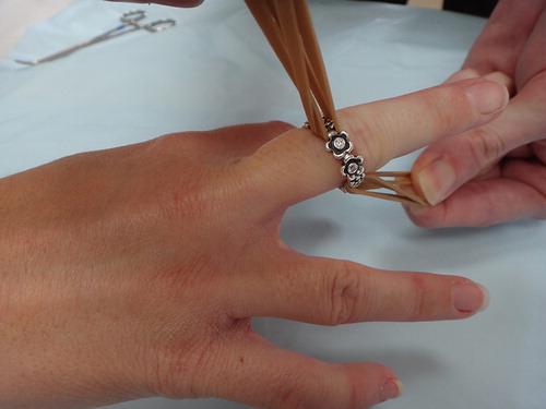 Two rubber band technique for finger ring removal – Improbable Research